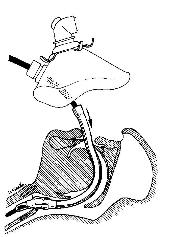 Airway Management for Maxillofacial Surgery